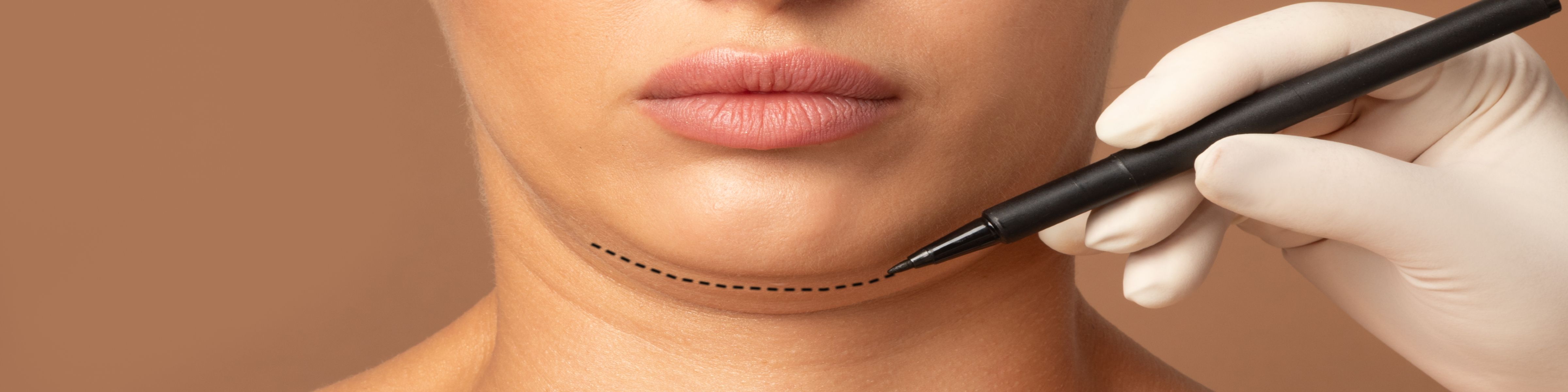 Kybella® Fat-Dissolving Injections for Double Chin | MeTime